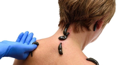 Leech therapy: why the procedure has no place in the 21st century ...